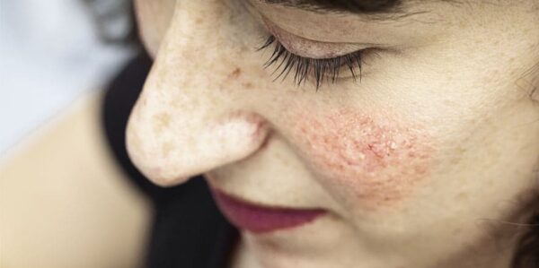Effective Acne Rosacea Treatment in Los Angeles | Dr. Brian Mekelburg